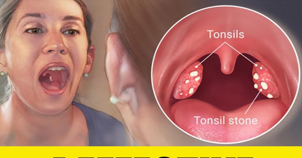 4 EFFECTIVE WAYS TO REMOVE TONSIL STONES WITHOUT SURGERY - HEALTH and WELLNESS