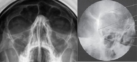 Estudo Radiográfico : ROTINA DE ÓRBITA