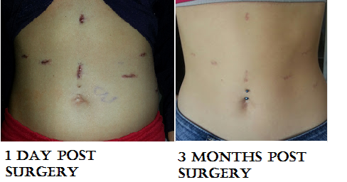 Nissen Fundoplication Scar