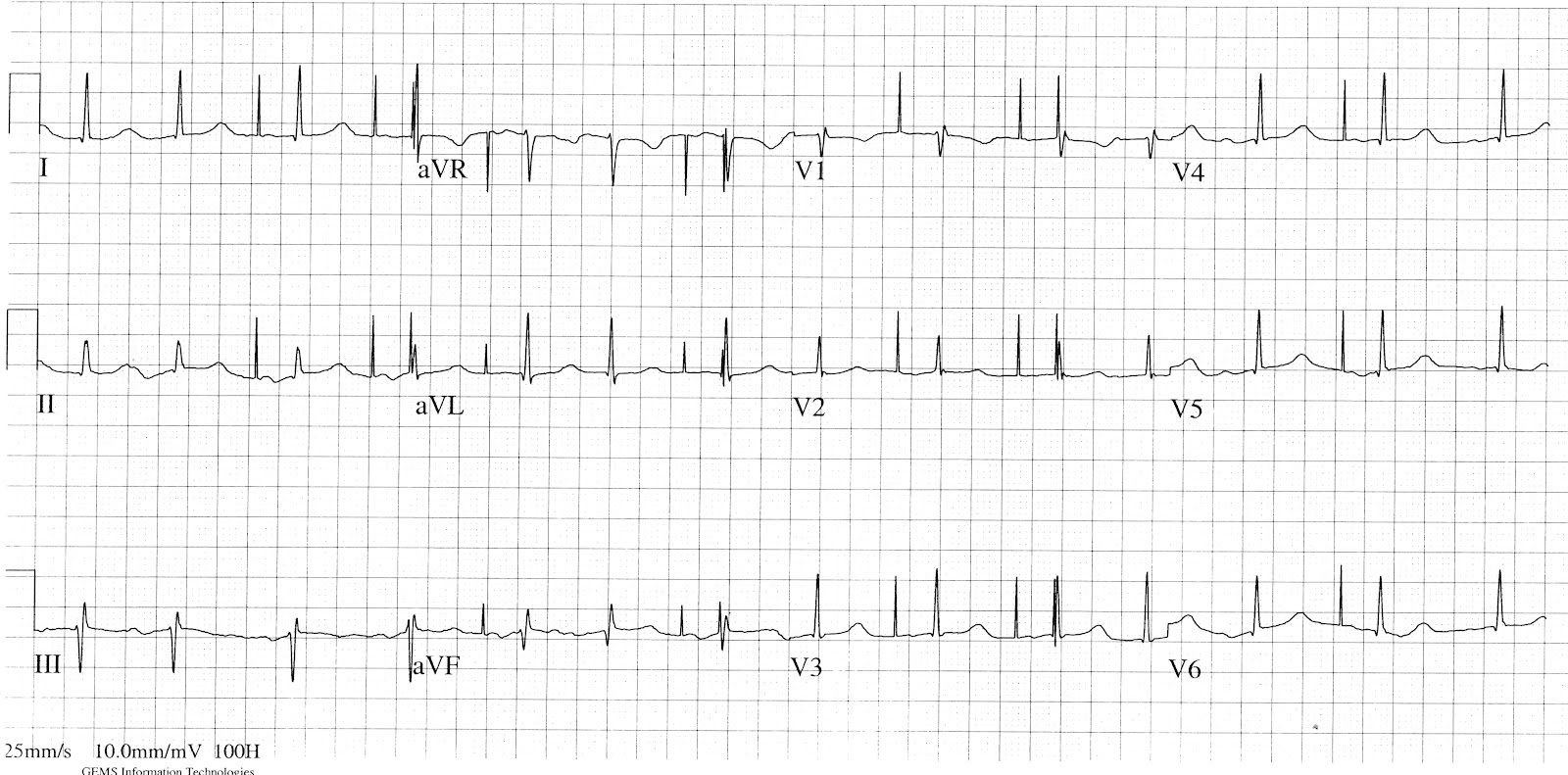 Cardiac Nurse: Teaching As I Learn: DDD pacing with psuedo fusion