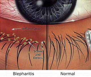 Hypnotic Lashes Blog: Blepharitis the enemy of eyelash extensions!!