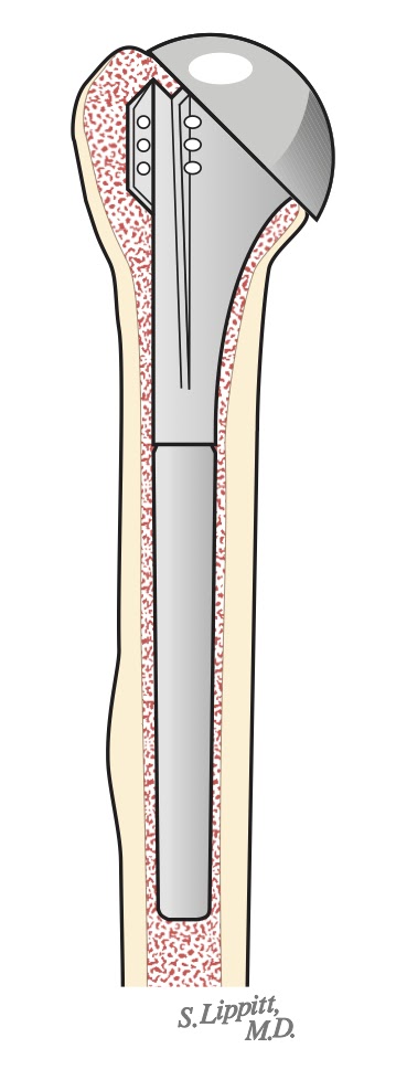 Stress shielding, component positioning with the Arthrex humeral stems ...