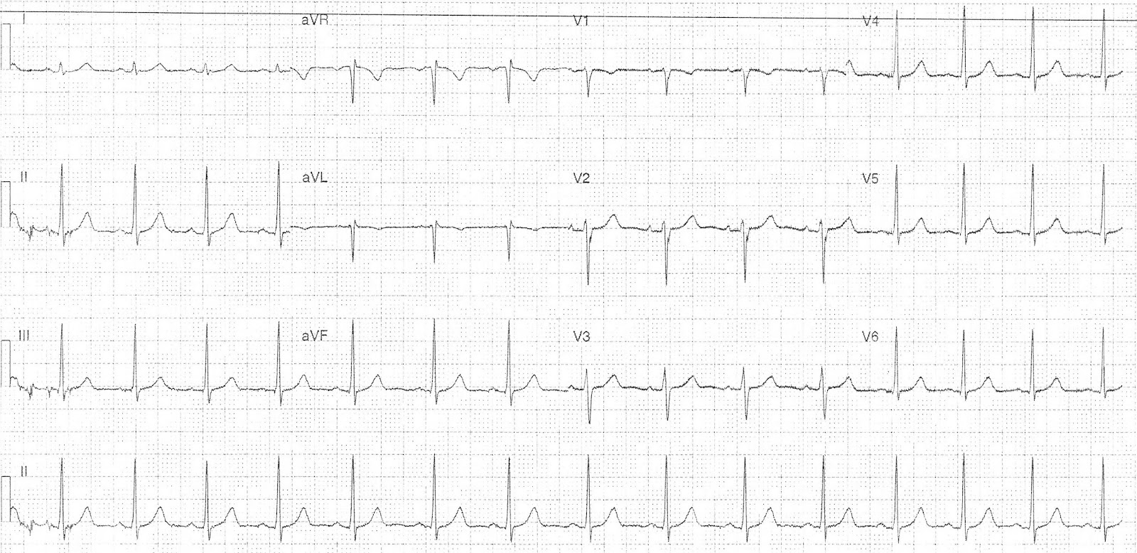ECG of the Week: ECG of the Week - 1st May 2017 - Interpretation