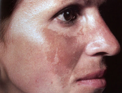 Fashion & Beauty: Melasma Upper Lip Pigmentation