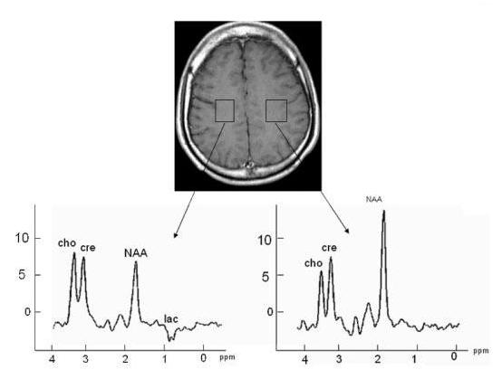 ABC Radiology Blog: Rasmussen's Encephalitis MRI Findings