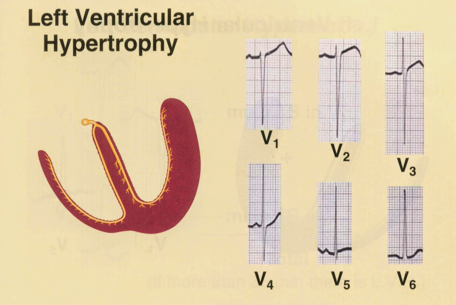Left Ventricular Hyperthrophy | INA - ECG