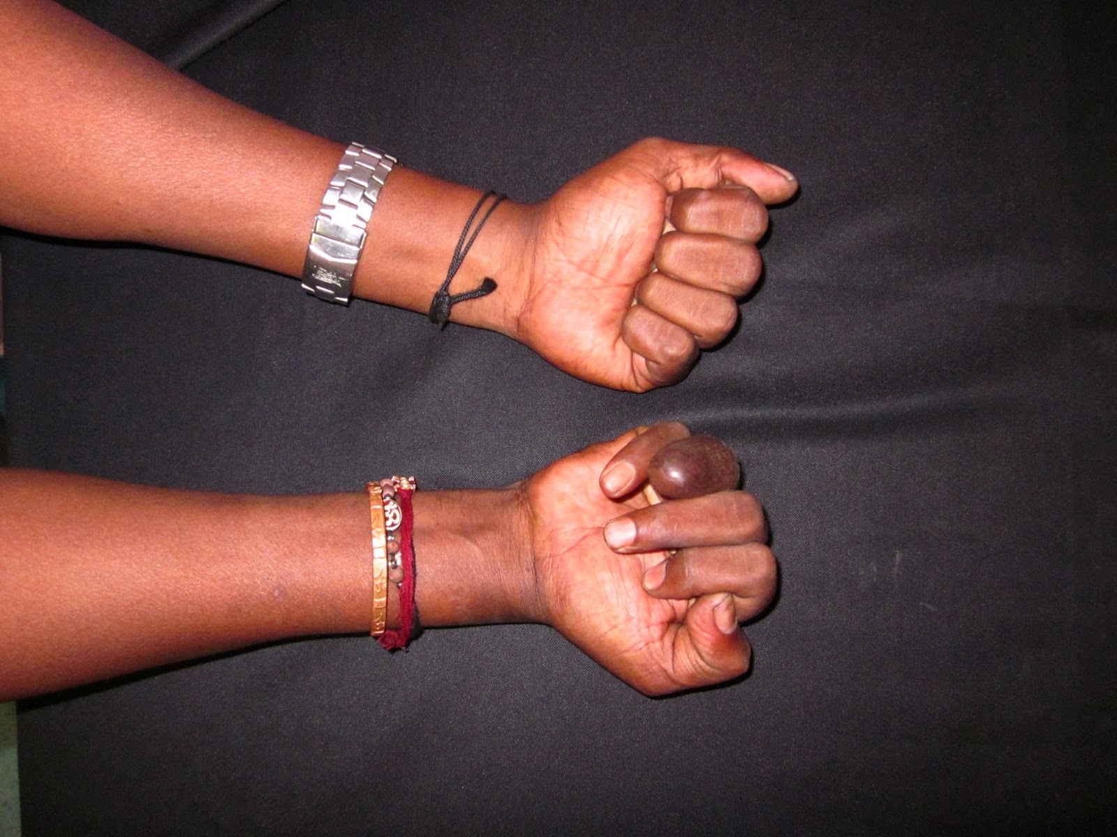 Crushing Injury Of Finger at Shelly Hampton blog