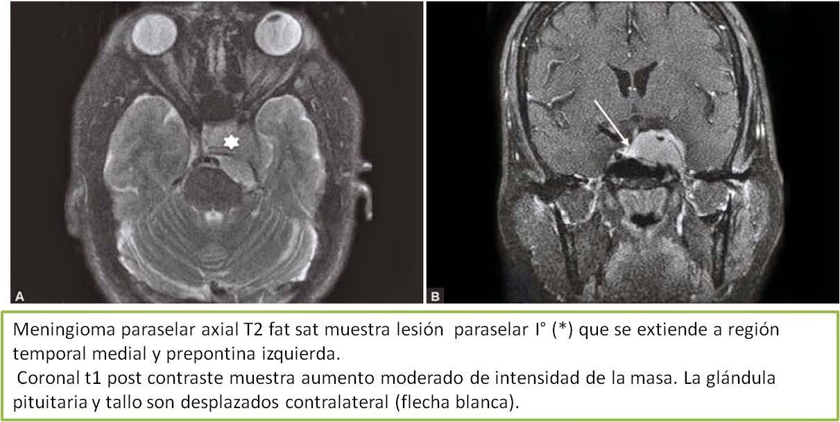 ESPE 203-2013: Patología de región selar: rol de imagenología