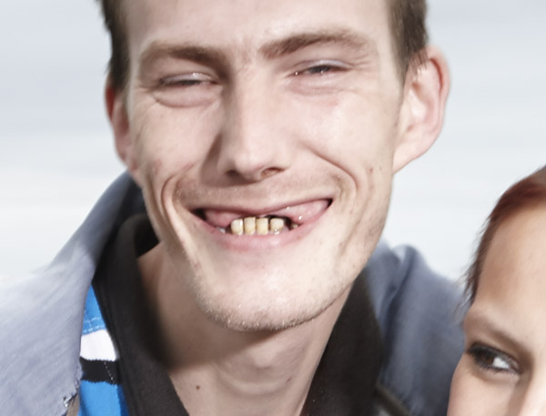 Richard Ansett: Meth Mouth