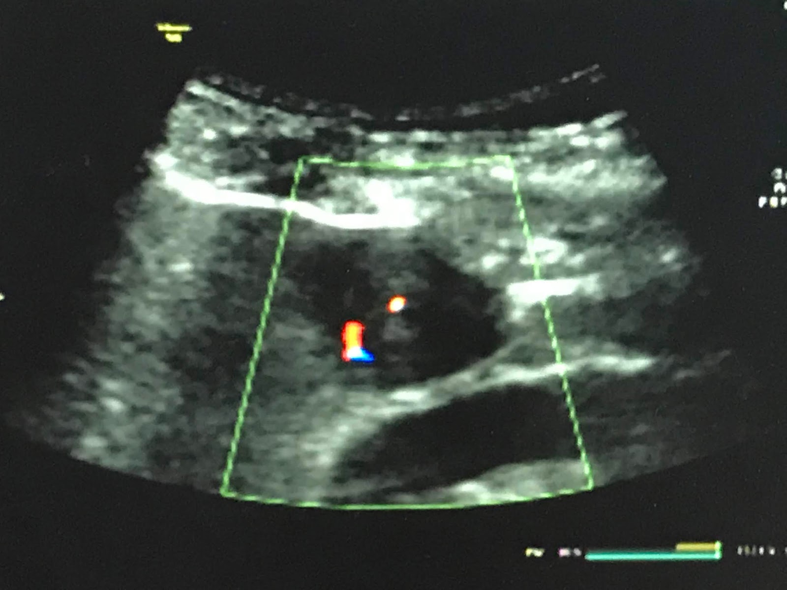 VIETNAMESE MEDIC ULTRASOUND: CASE 520: LIVER TUMOR WITH LOW AFP, Dr ...