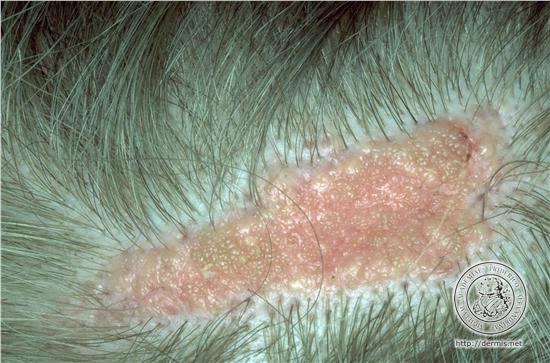 Coisa Acadêmica: Síndrome do Nevus Organóide (Nevo Sebáceo)