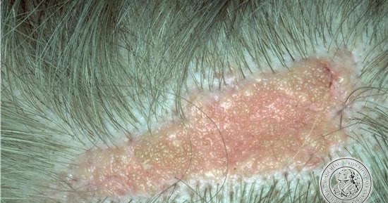 Coisa Acadêmica: Síndrome do Nevus Organóide (Nevo Sebáceo)