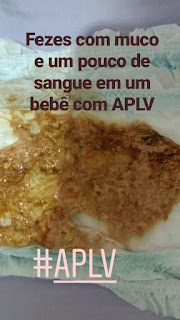 Dra. Daniela Mendonça Gastropediatra: Muco nas fezes