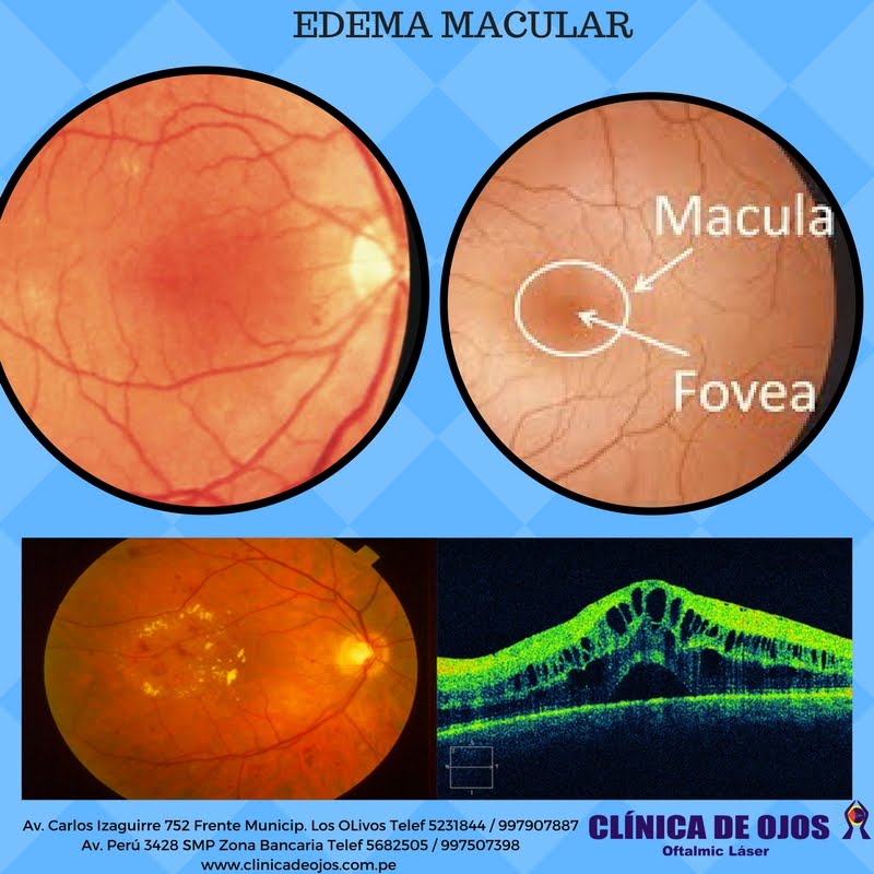 Clínica de Ojos Oftalmic Láser: EDEMA MACULAR