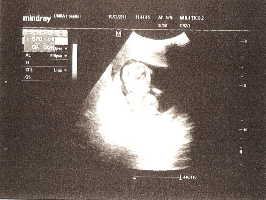 My Pregnancy Day and Progress...: Gambar scan babies...