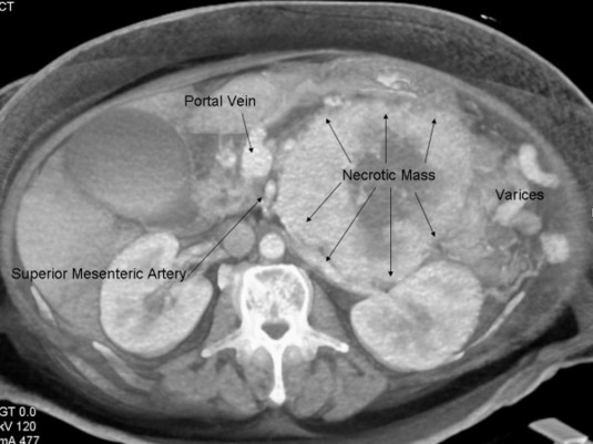 Verner-Morrison syndrome - meddic