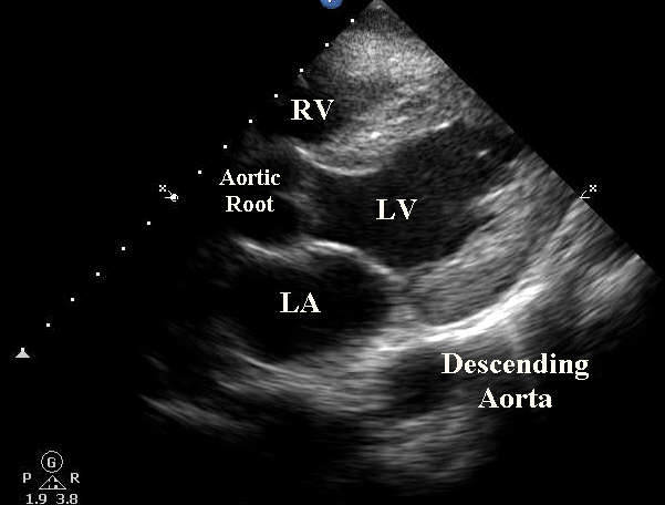 TTE for Aortic Dissection/ Thoracic Aneurysm? ~ Ultrasound Cases Info