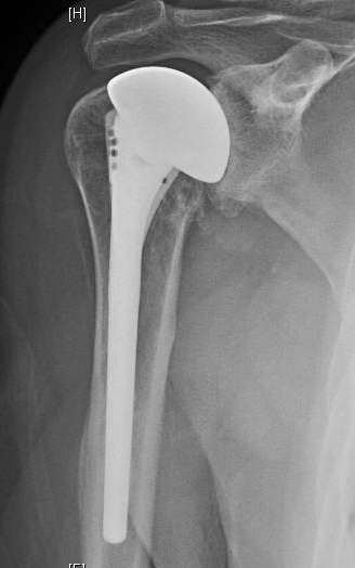 UW Shoulder and Elbow Academy: What is an "infection" of a shoulder ...