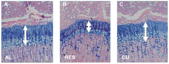 Treating Achondroplasia: Tratando la acondroplasia: BMN-111 y el ...