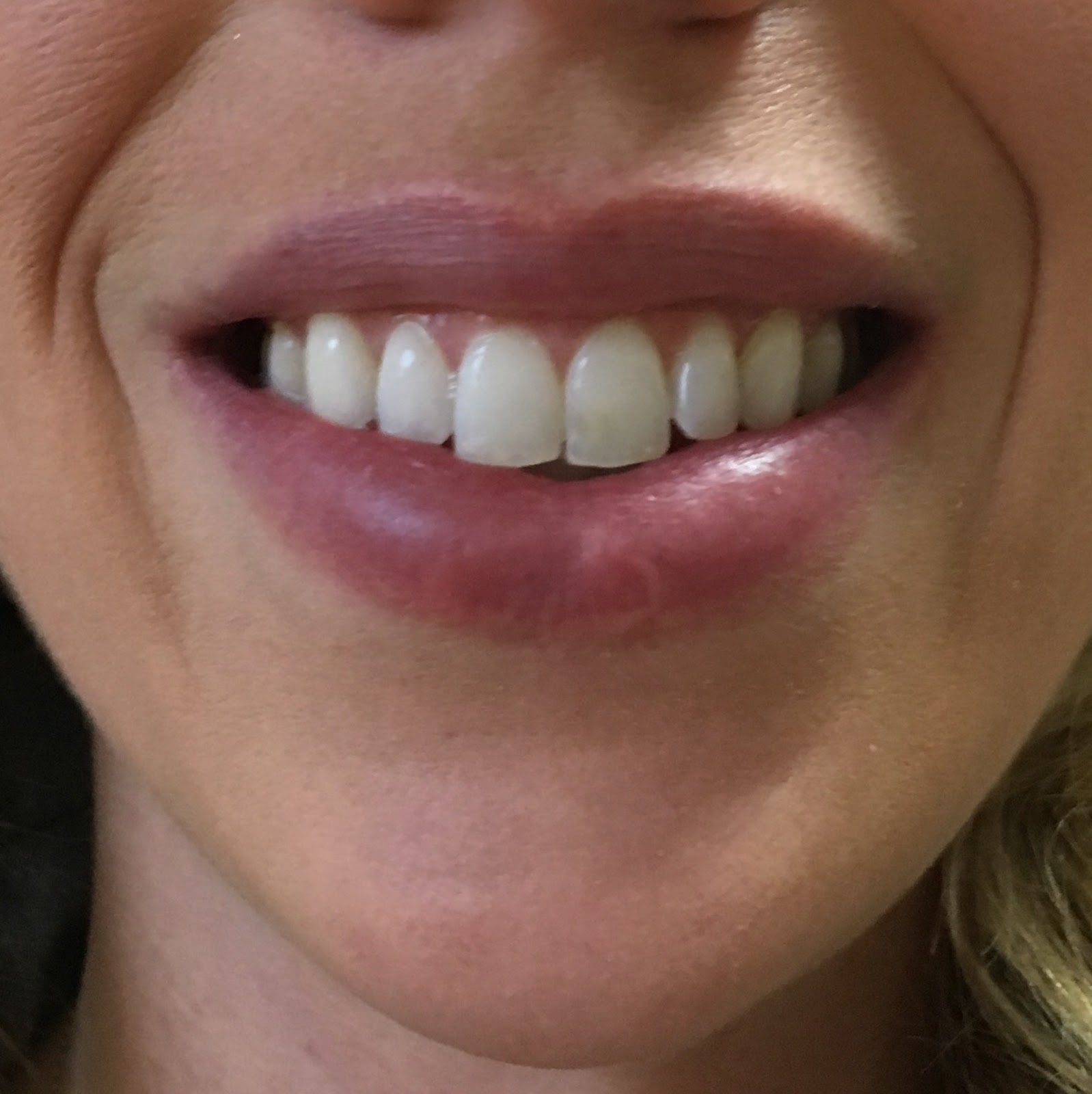 Sparkles and Lattes: At Home Teeth Whitening with Smile Brilliant