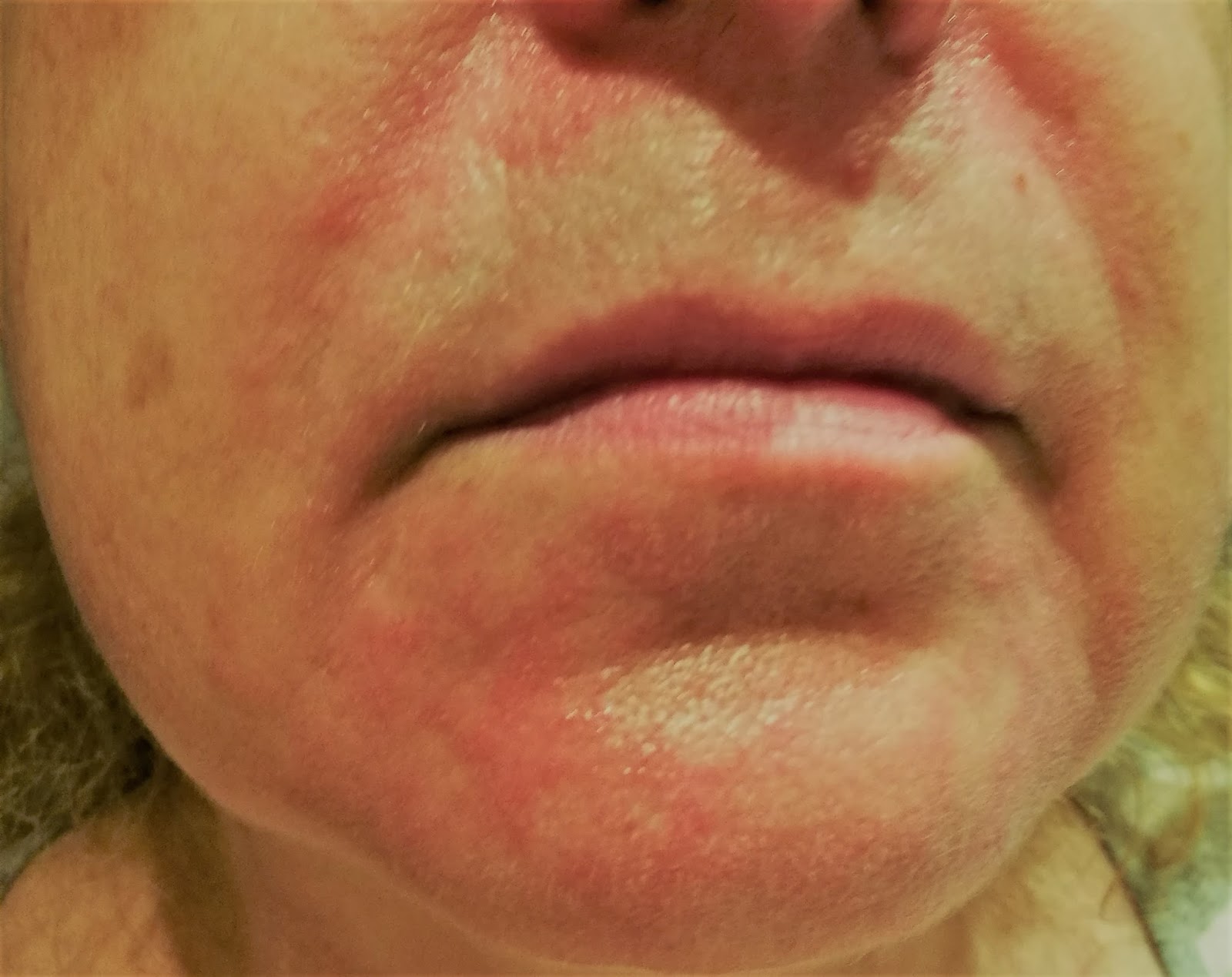 Cuidarse a los 50: Dermatitis seborreica