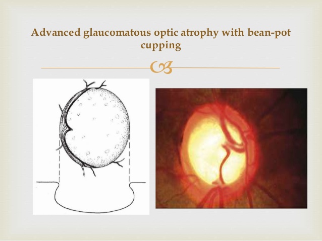 GLAUCOMA SPECIALIST BLOG: "THE GLOG"