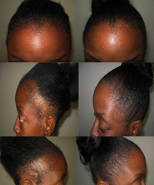 Ex-bald haired man discovers top secret that regrew his bald hair and ...