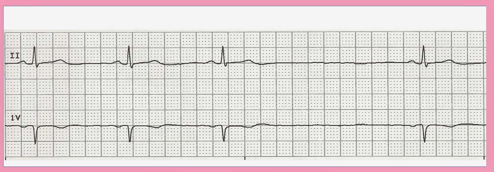 EKG Rhythm Strip Quiz 186
