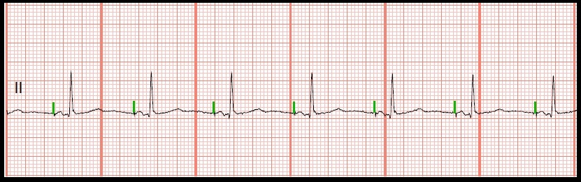 Practice EKG Rhythm Strips 182