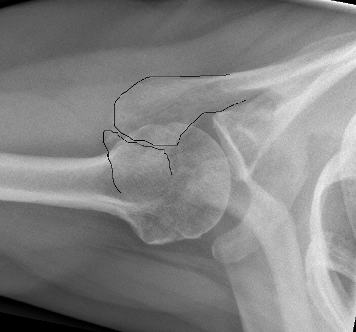 Os Acromionale - India Ortho Surgeon