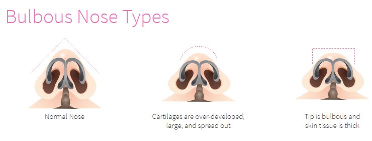 TL Eyeplasty, Rhinioplasty, and Facial Contouring: Surgery for Bulbous ...