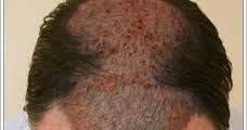Hair Transplant Clinic: If am Facing Frontal Baldness What I need to do?