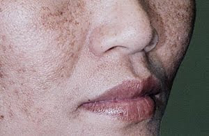 Fashion & Beauty: Melasma Upper Lip Pigmentation