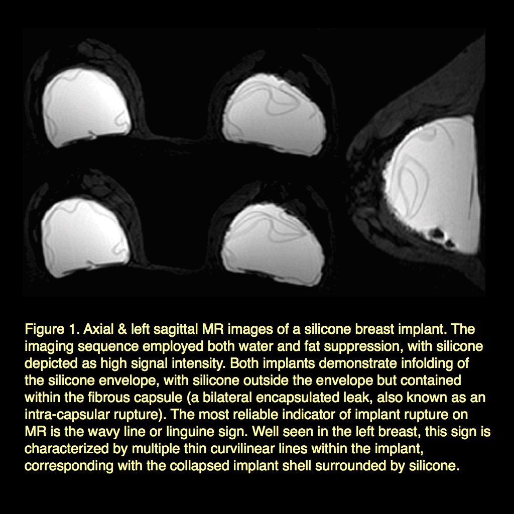 MRI BLOG: MRI of Silicone Breast Implant