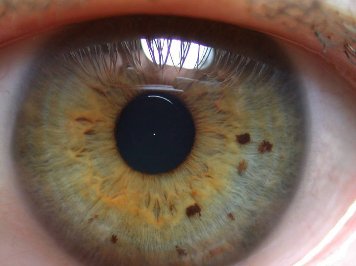 Modern & Multidimensional Iridology: Dyscratic Diathesis, Central ...