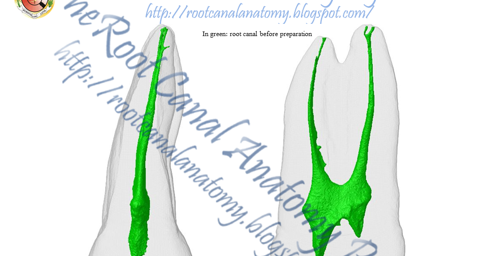 The Root Canal Anatomy Project: Conservative Endodontic Access ...