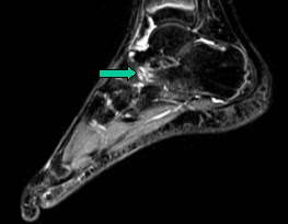 mricases: Calcaneonavicular Coalition - Fibrous/Cartilaginous