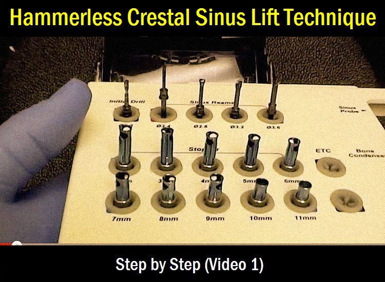 IMPLANTOLOGY: Hammerless Crestal Sinus Lift Technique - Step by Step ...