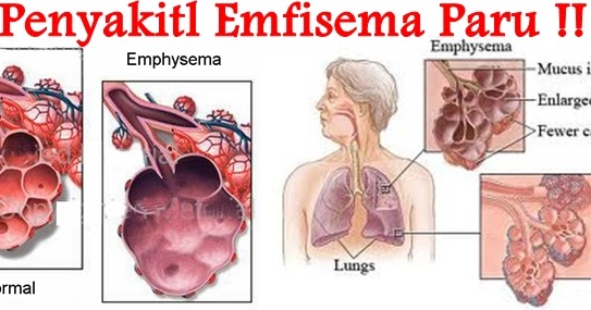 APA ITU PENYAKIT PARU PARU EMFISEMA