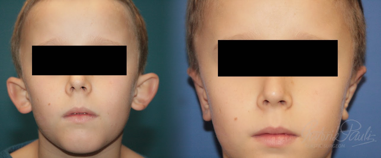 MUDr. Patrik Paulis : Plastika uší - otoplastika