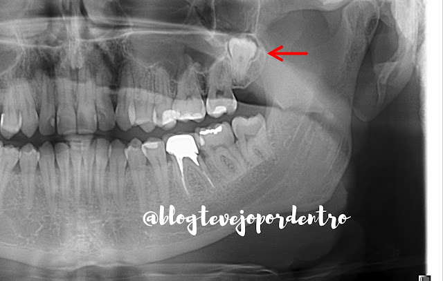 "Te vejo por dentro": Dente 28 invertido