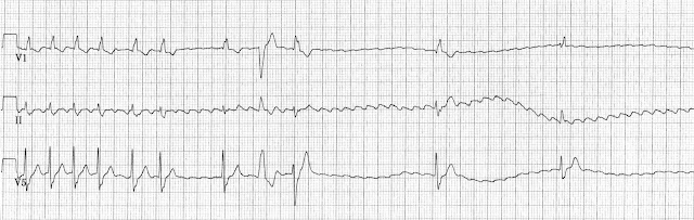 Dr. Smith's ECG Blog: An apparent SVT that does not persistently ...