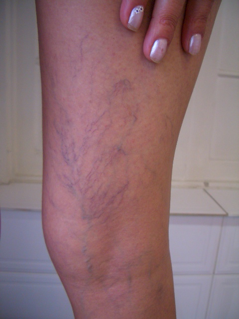 Doenças do sistema circulatório.: Varizes