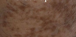 How to remove black or dark spots from my body hip,legs,waist,back ...