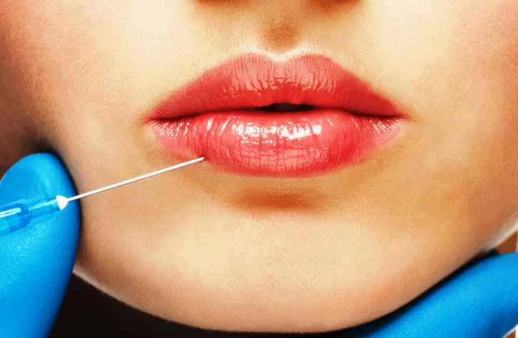 What Are the Different Types of Lip Augmentation Procedure? - Best ...
