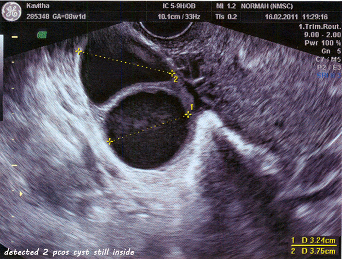 Ruthies's Journal: 8 Weeks Ultrasound Scan Photos
