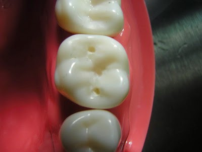 Operative Dentistry: Class I Cavity preparation & restoration on ...