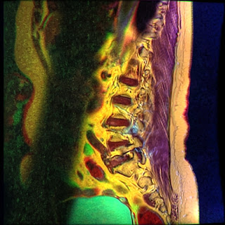 Nevit's blog: Color MRI of Lumbar vertebrae
