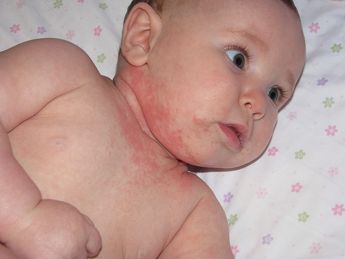 Baby Allergies - How to handle it when your Child Endures an Attack ...
