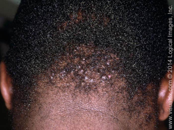 Acné Keloidalis Nuchae Antes Y Después